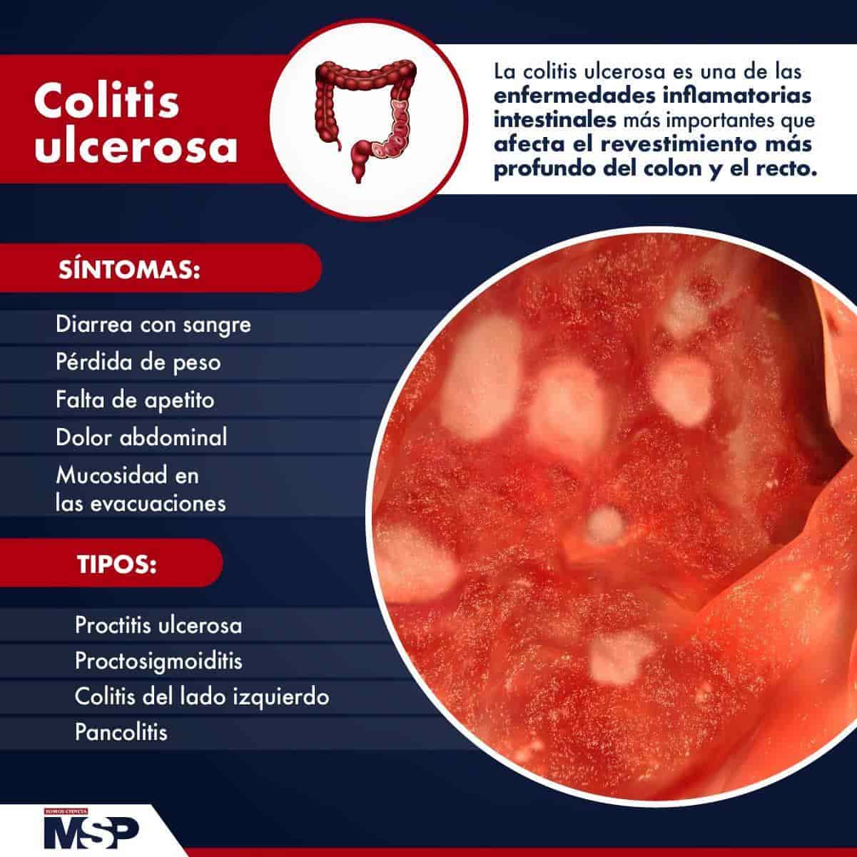 Colitis ulcerosa: síntomas y tipos