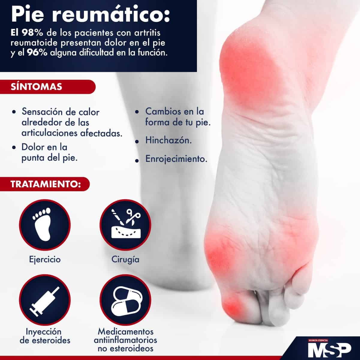 Pie reumático: síntomas y tratamiento