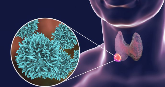 La FDA aprueba el cabozantinib para el cáncer de tiroides diferenciado La FDA aprueba el cabozantinib para el cáncer de tiroides diferenciado