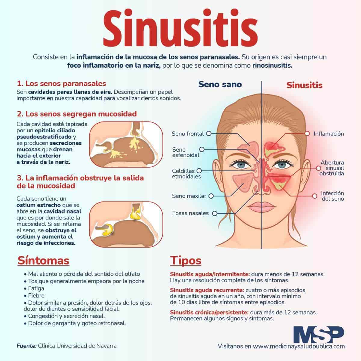 Sinusitis - Infografía