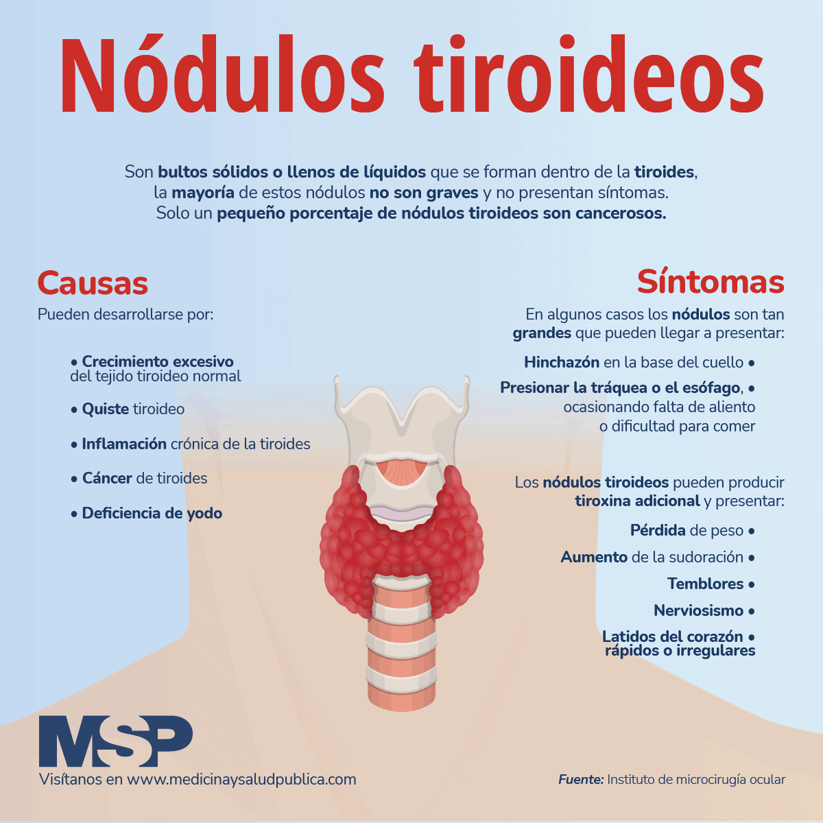 Nódulos tiroideos - Infografía