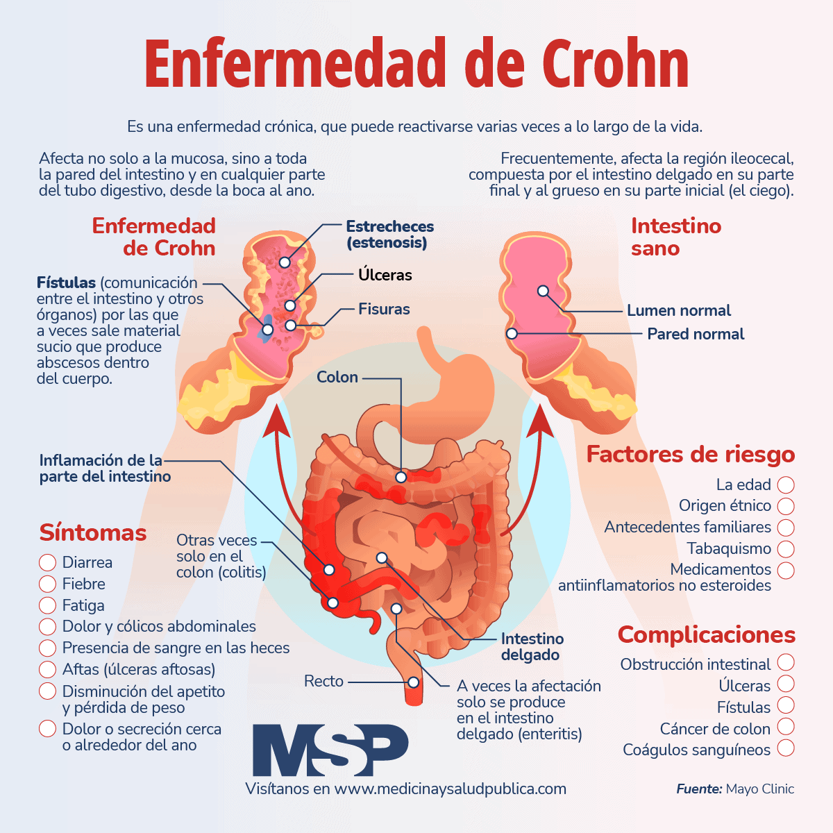 Enfermedad de Crohn - Infografía