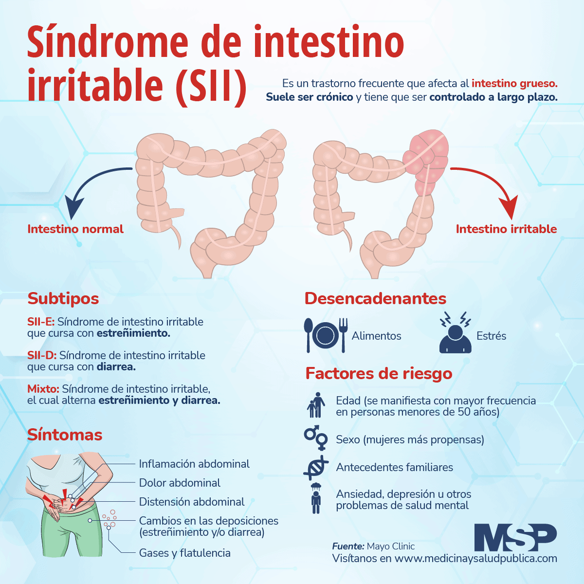 Síndrome de Intestino Irritable - Infografía