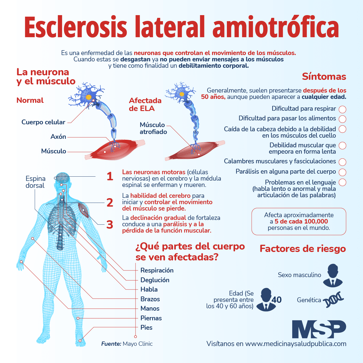 Esclerosis Lateral Amiotrófica - Infografía