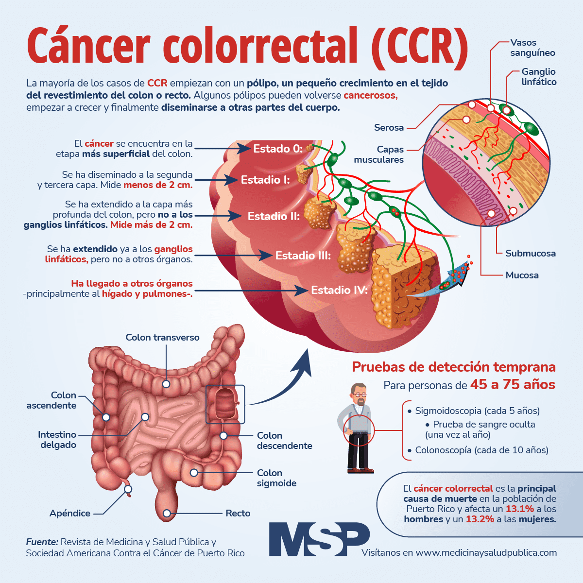 Cáncer colorrectal - Infografía