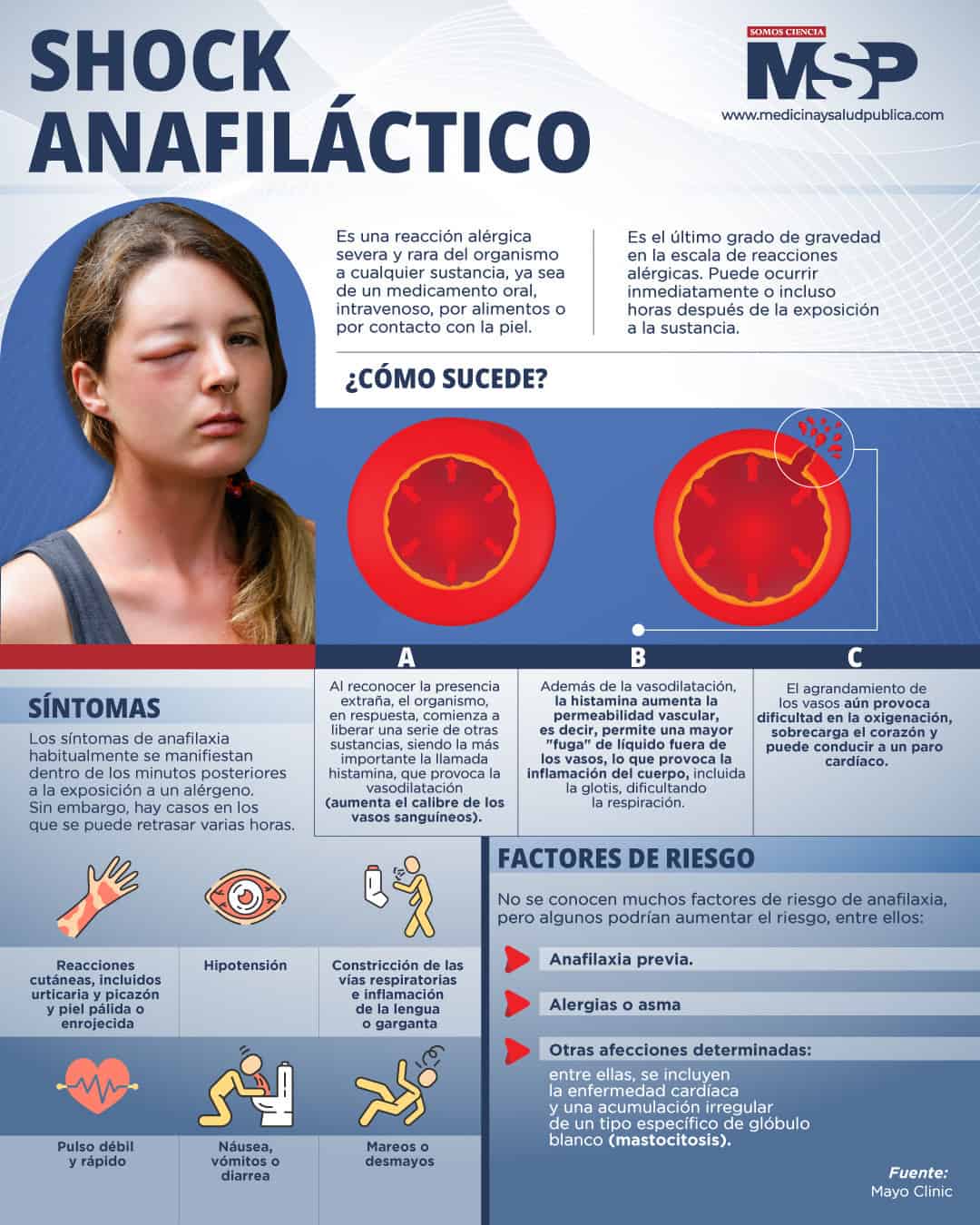 Shock Anafiláctico - Infografía