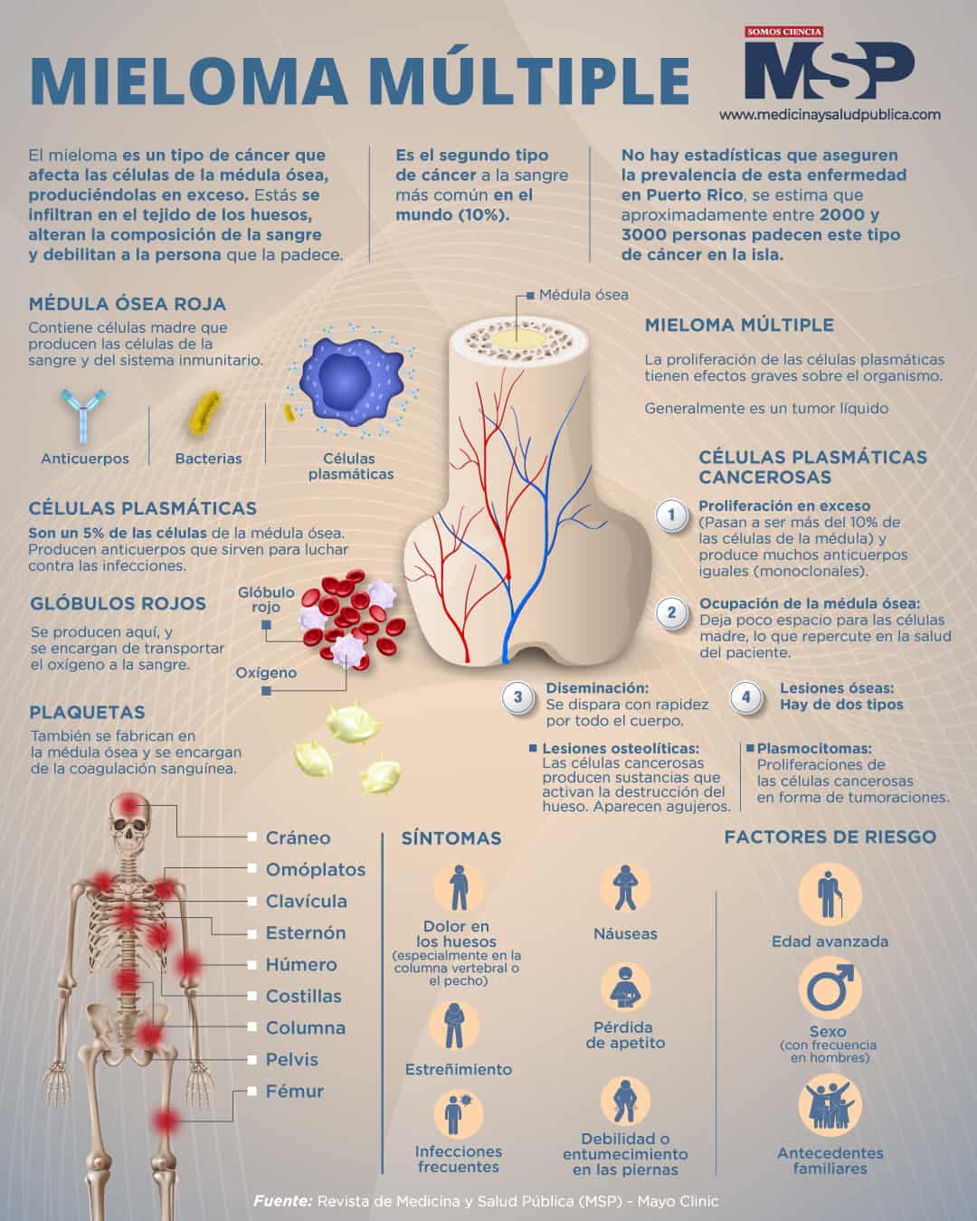 El mieloma múltiple - Infografía