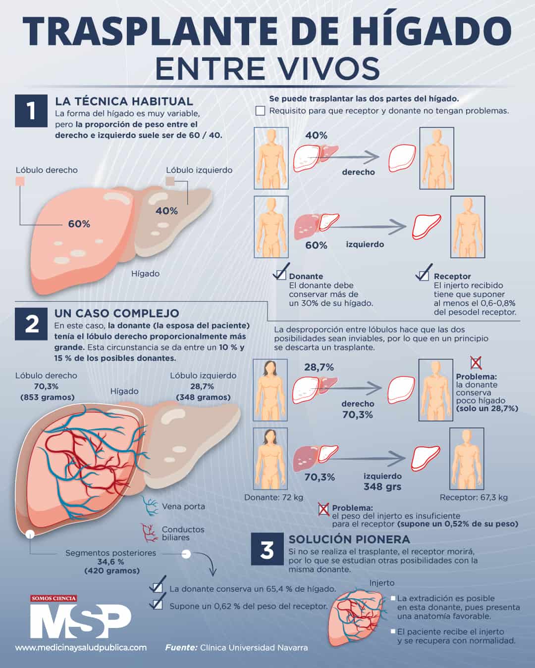 Transplante de hígado entre vivos - Infografía
