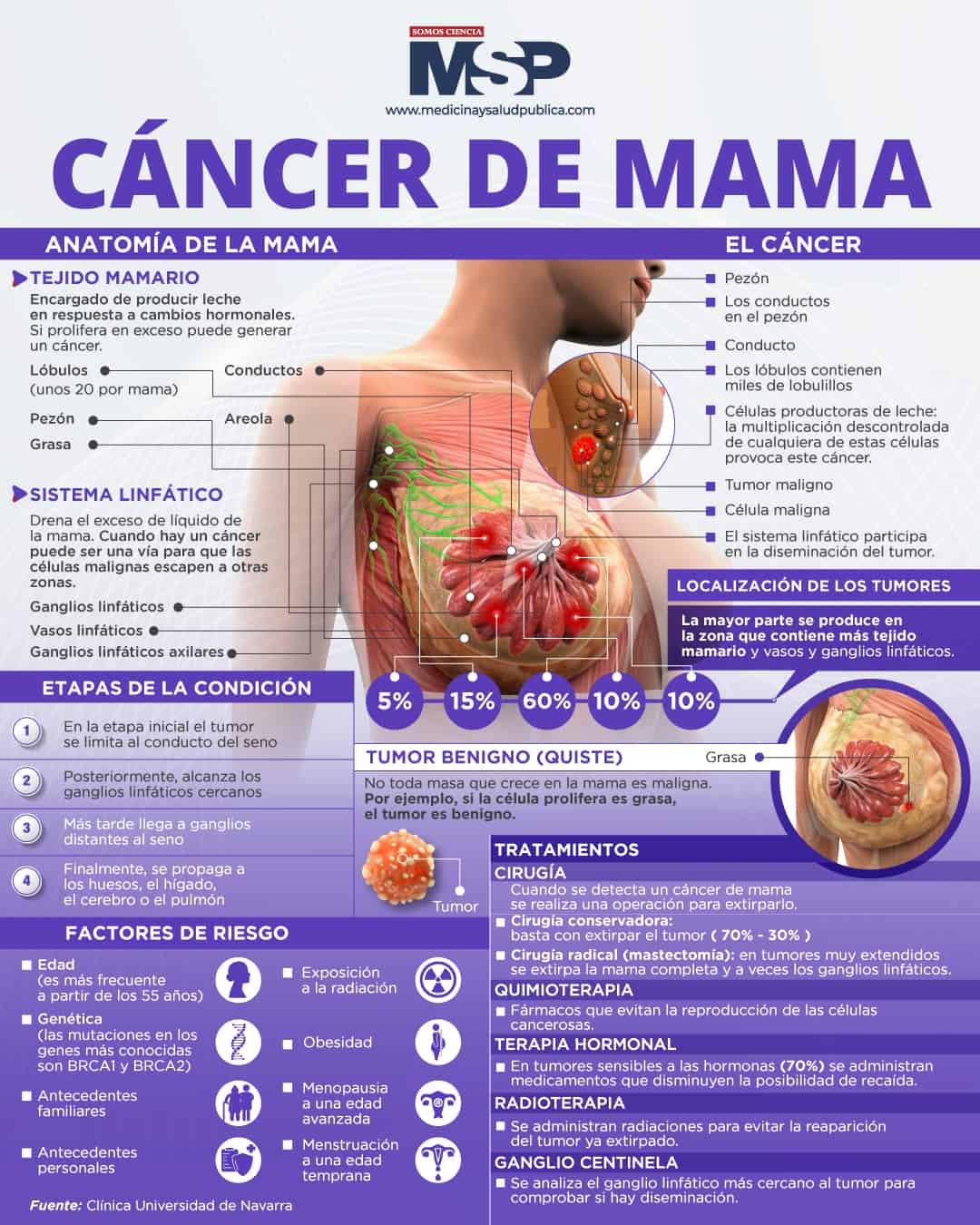 Cáncer de seno - Infografía