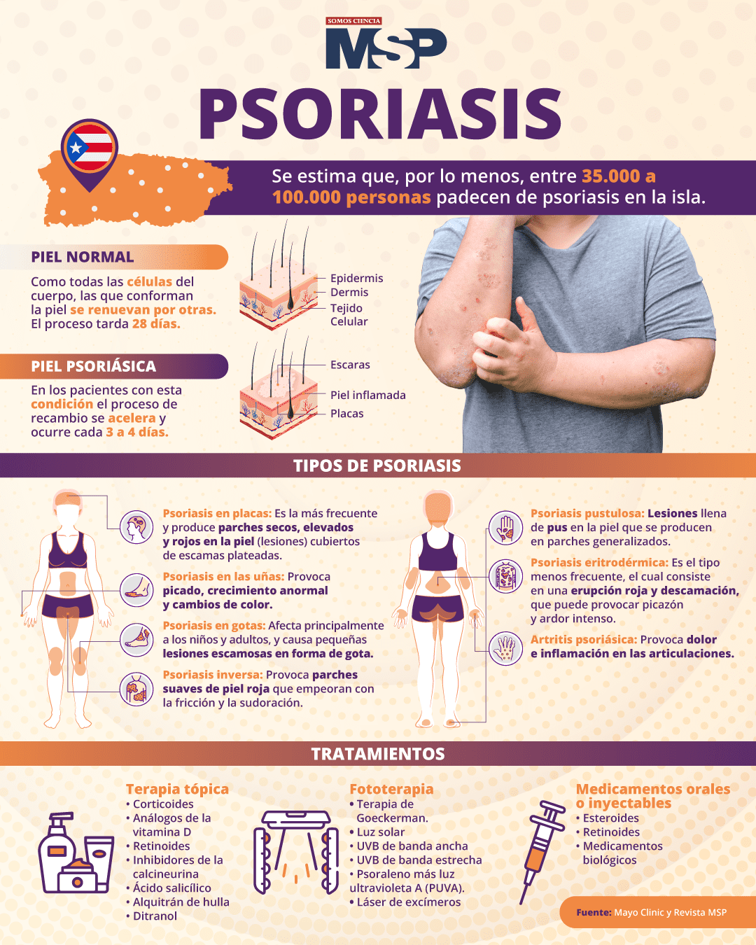 La Psoriasis - Infografía