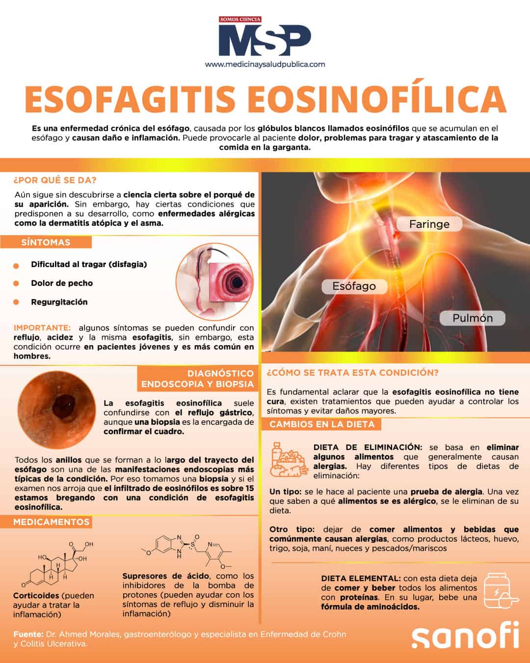 Esofagitis eosinofílica - Infografía