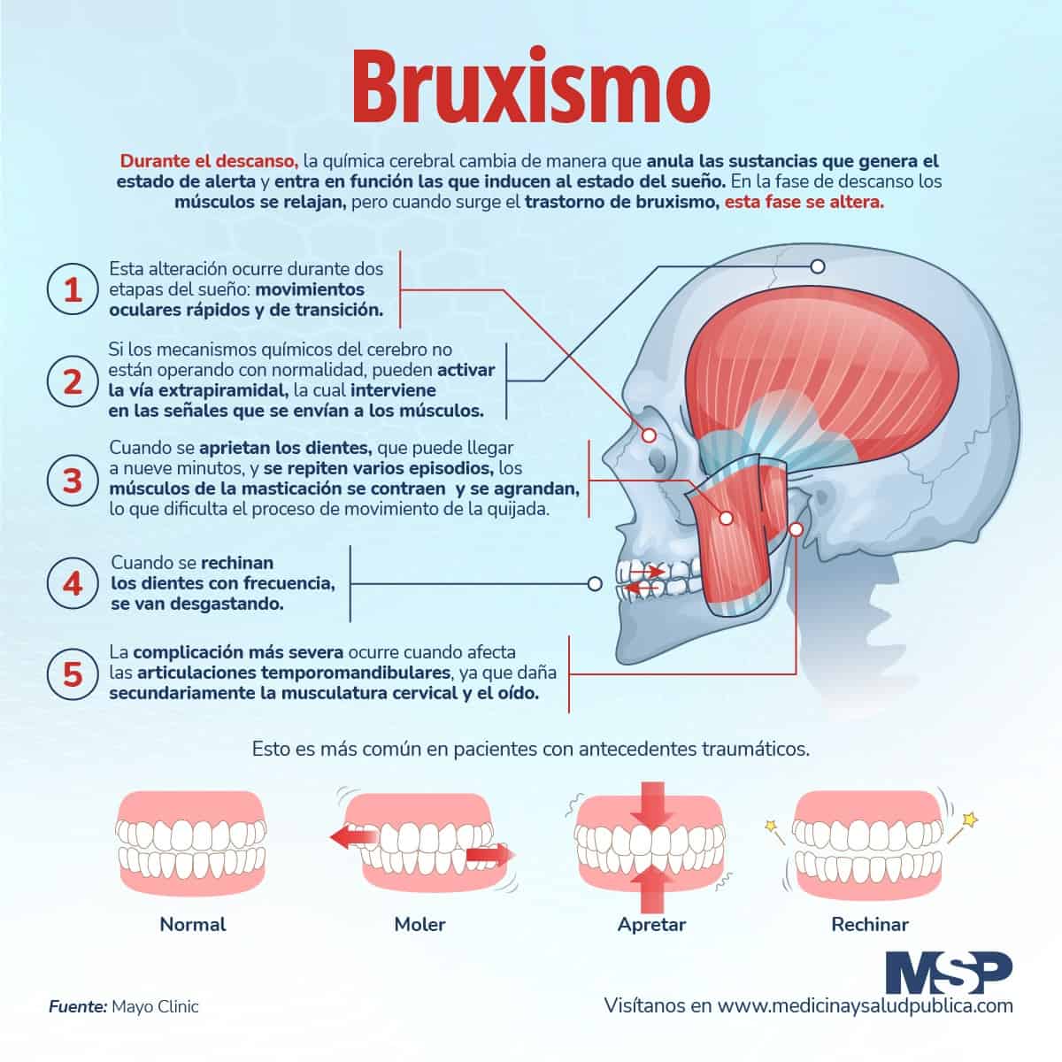 Bruxismo - Infografía