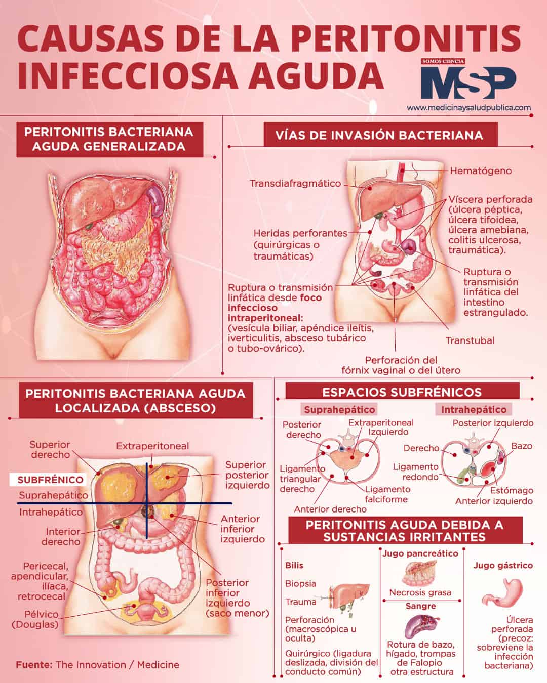 Causas de la peritonitis infecciosa aguda
