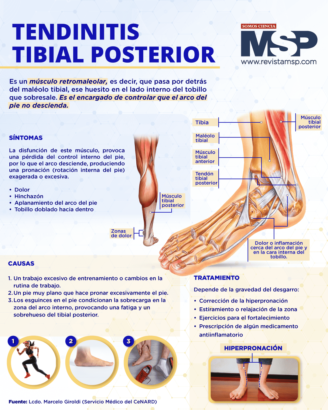 Tendinitis tibial posterior - Infografía