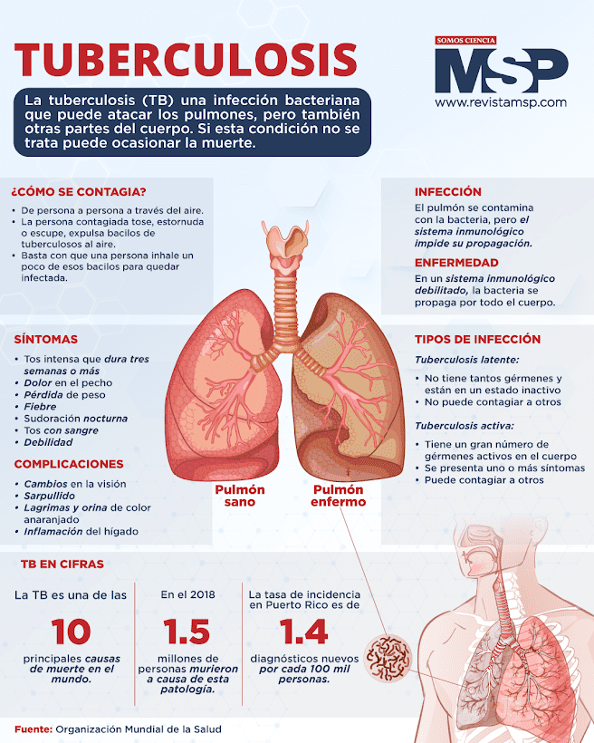 Tuberculosis - Infografía