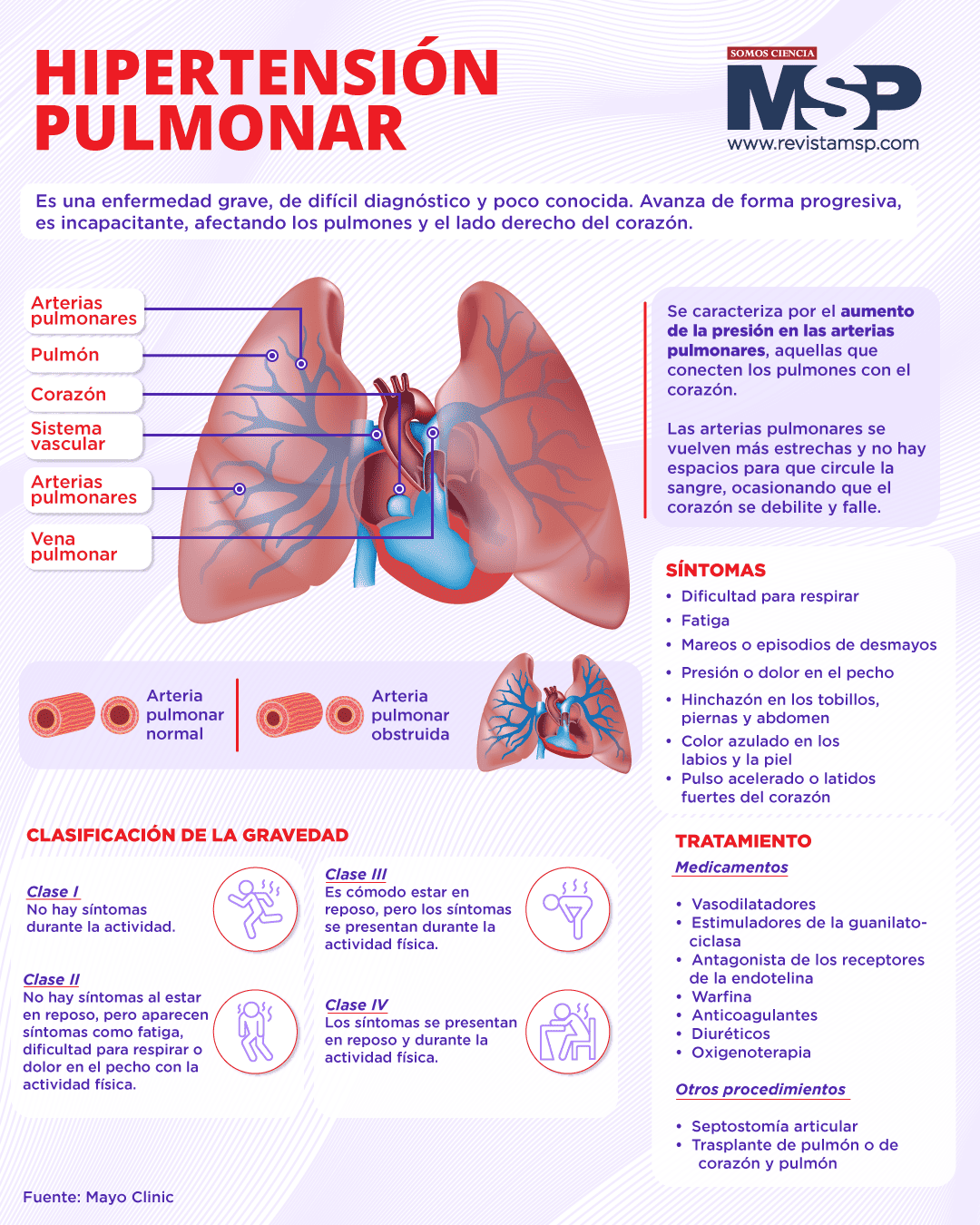 Hipertensión Pulmonar - Infografía