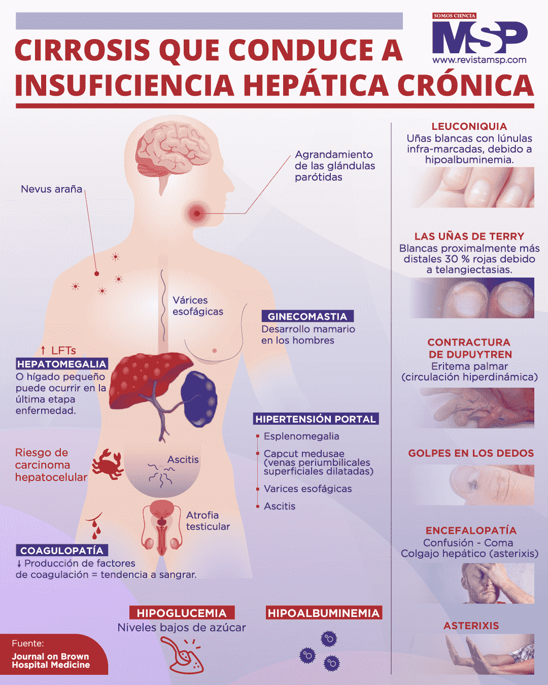 Síntomas De Cirrosis Hepática