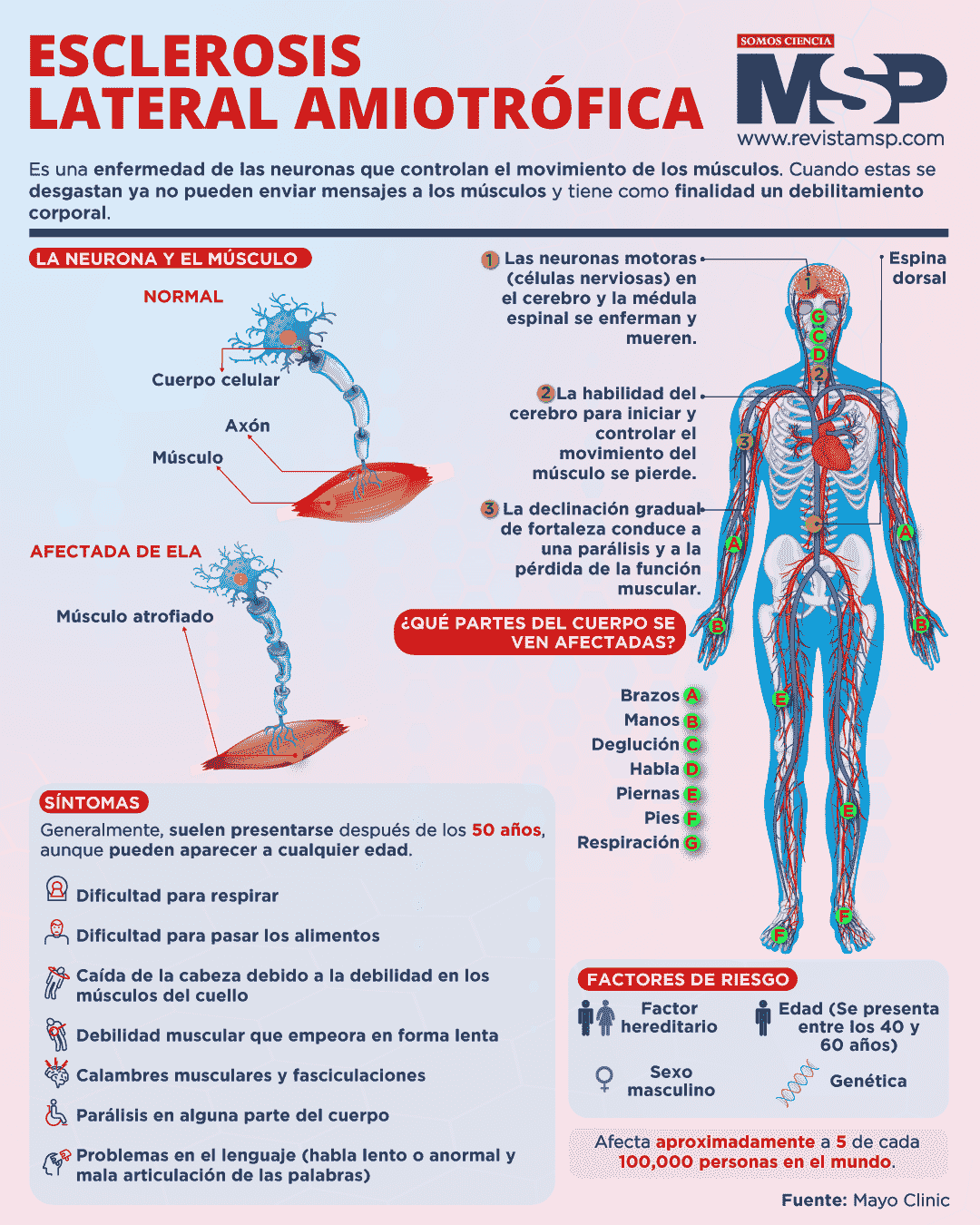 Esclerosis lateral amiotrófica