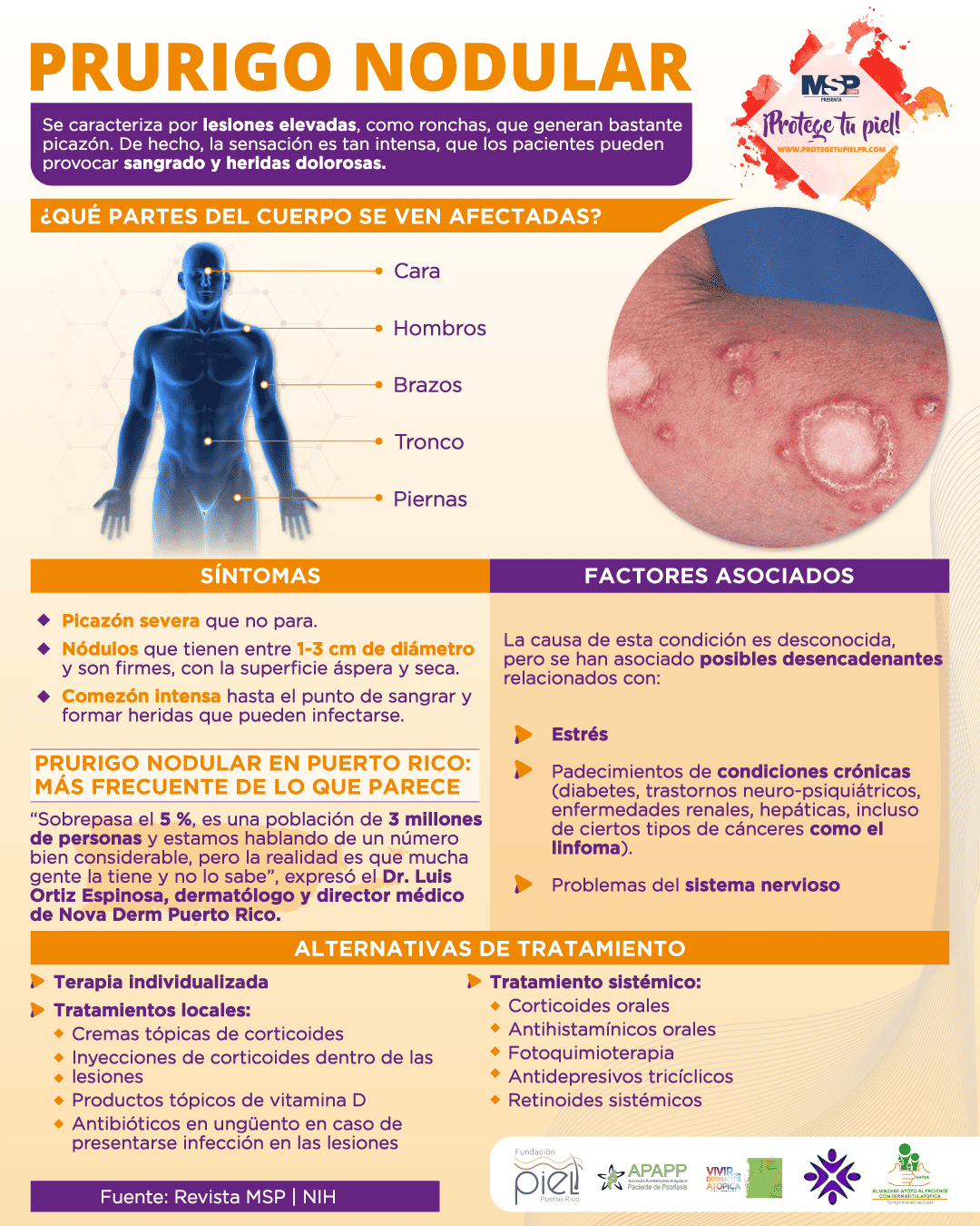 Prurigo nodular