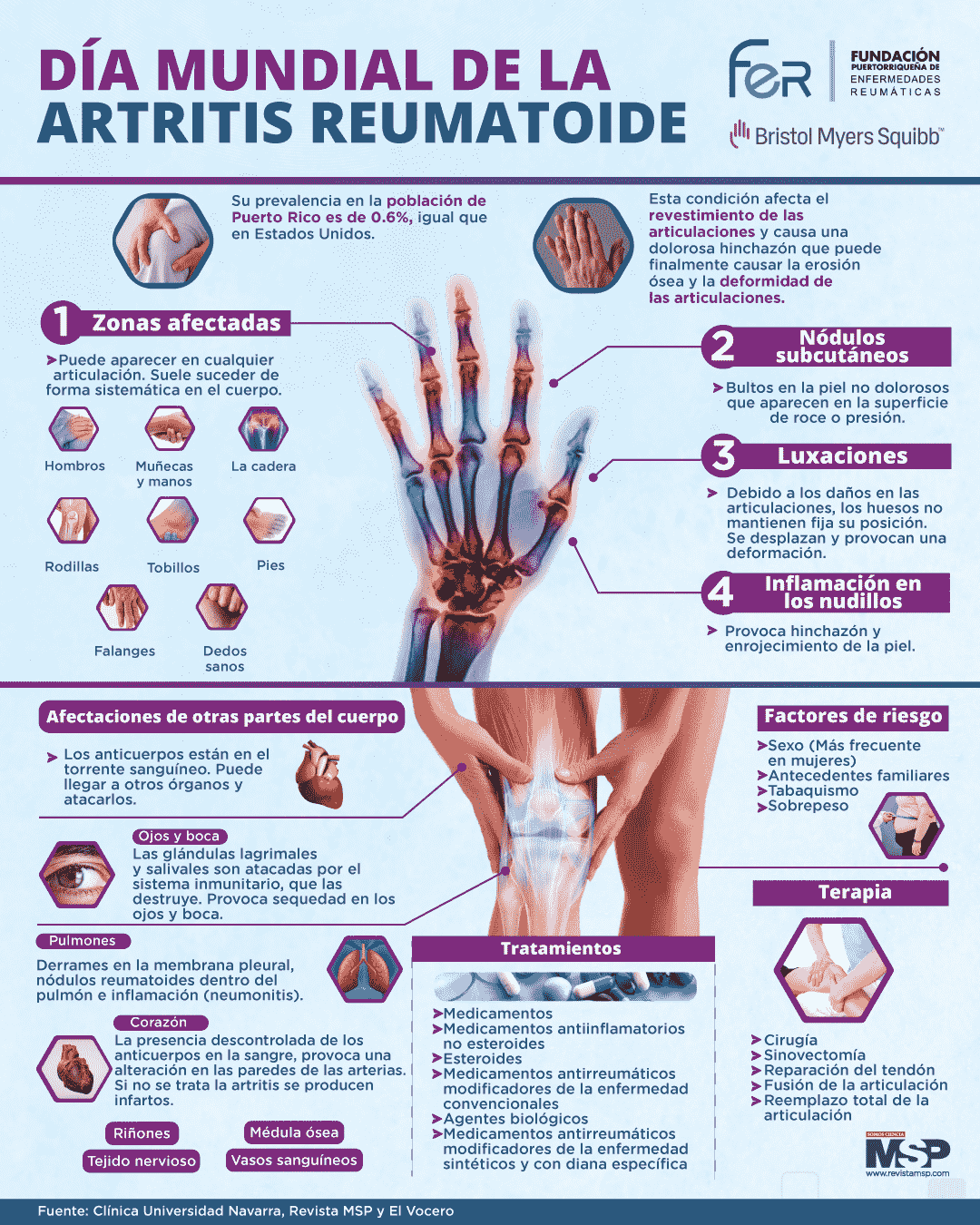 Artritis reumatoide