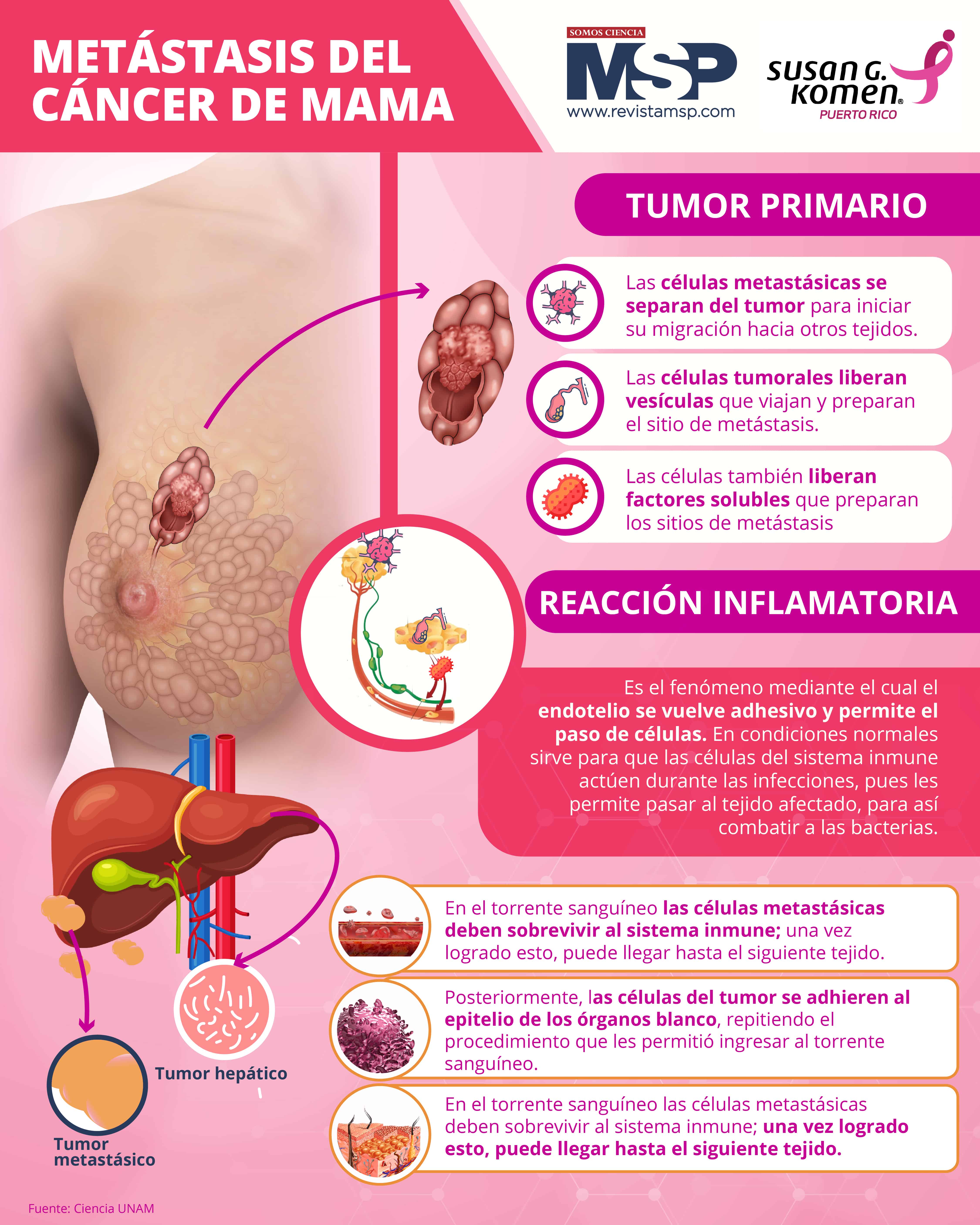 Metástasis del cáncer de mama