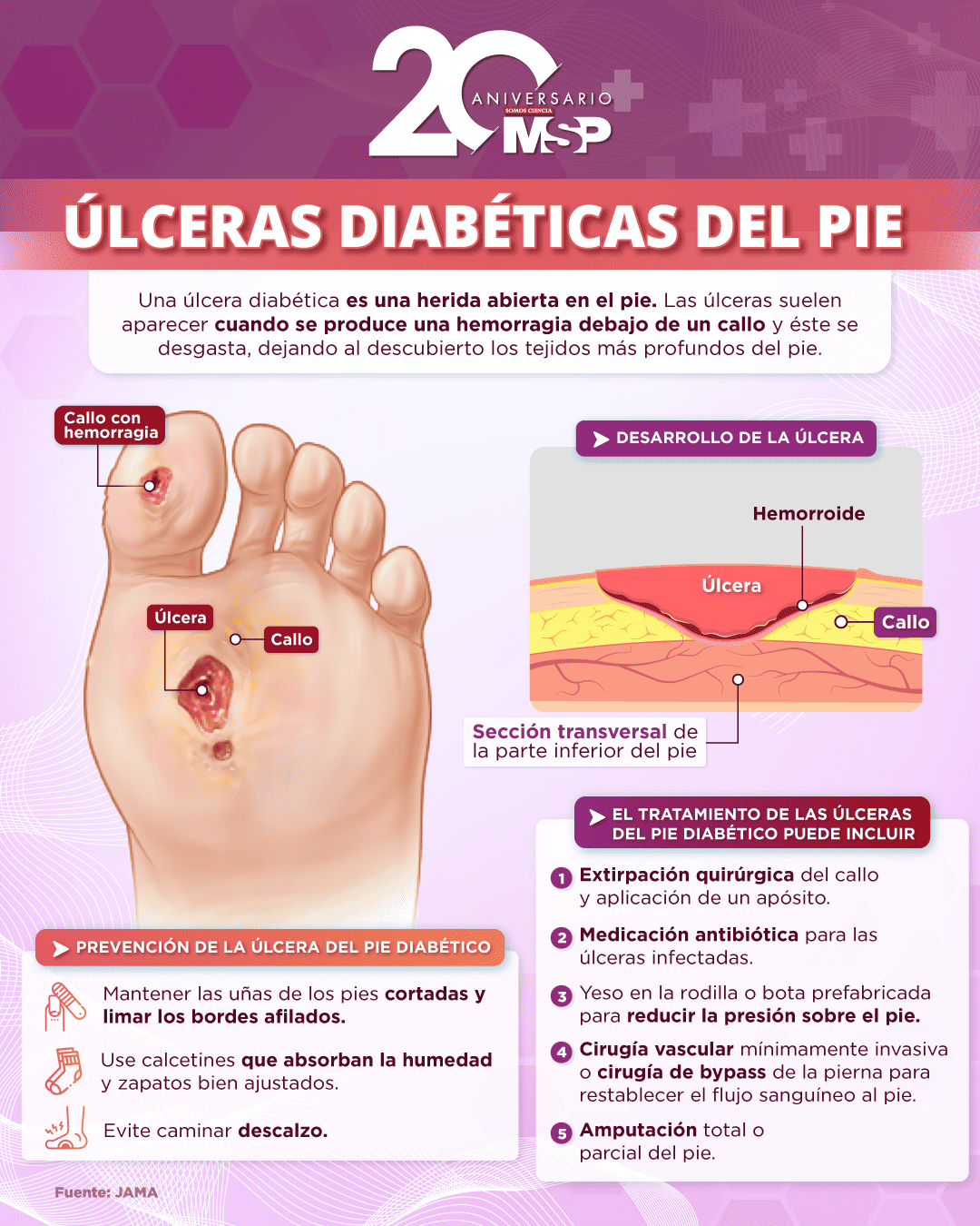 Úlceras diabéticas en el pie