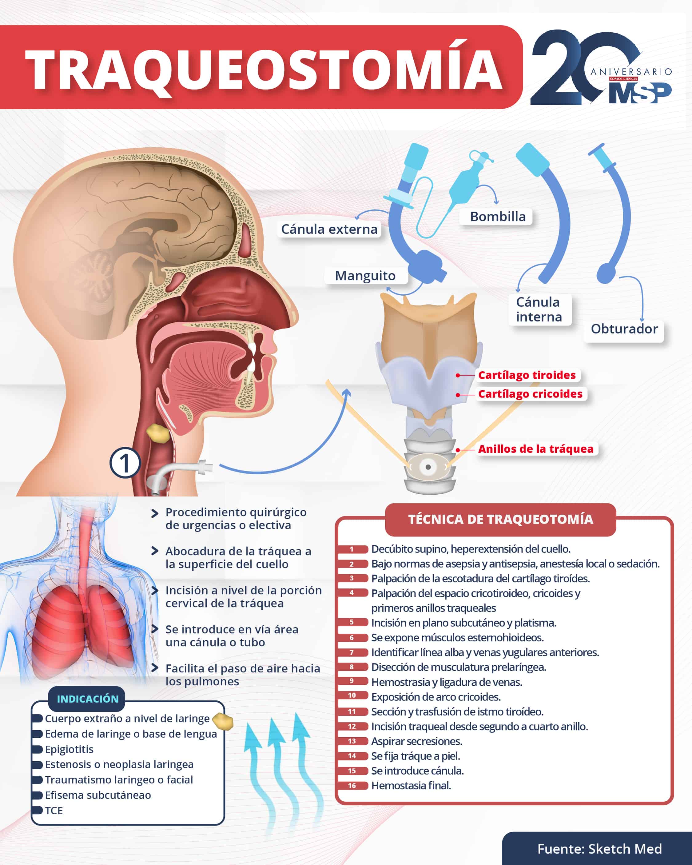Traqueostomía