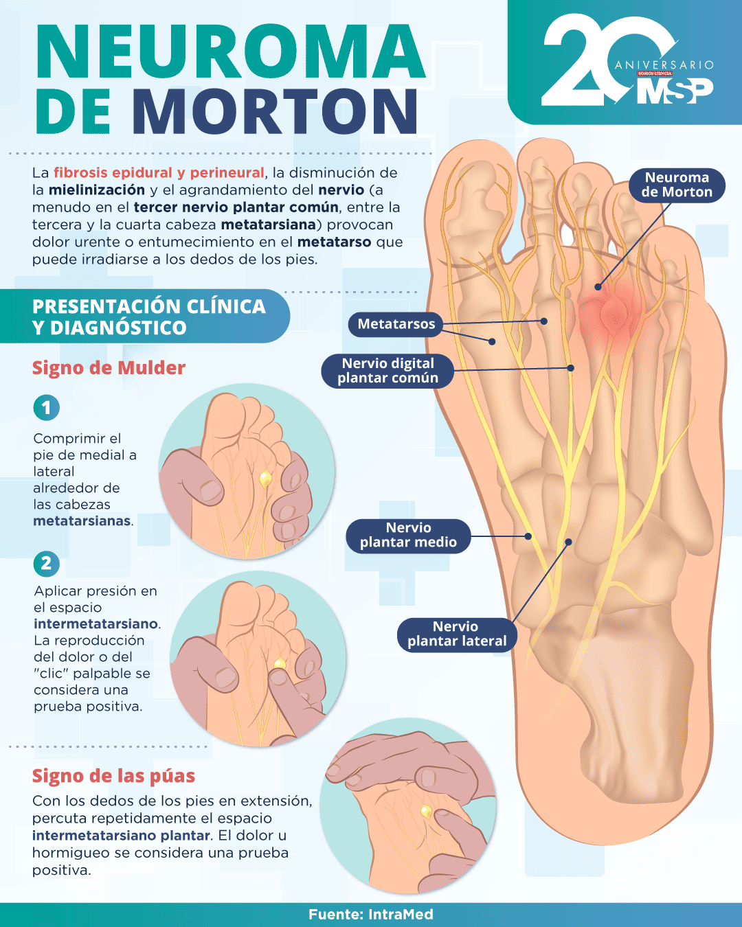 Neuroma de Morton