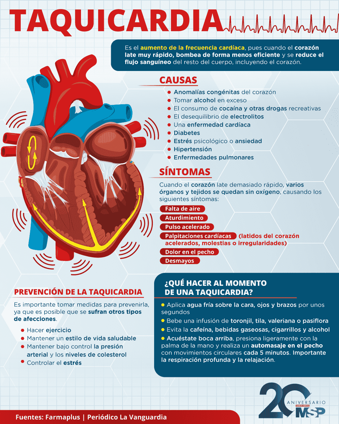Causas De Taquicardia Ventricular Electrocardiograma De Una