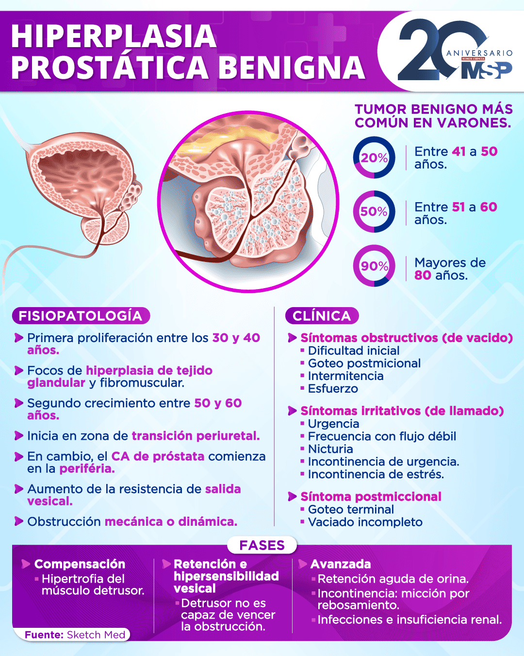 Hiperplasia prostática benigna