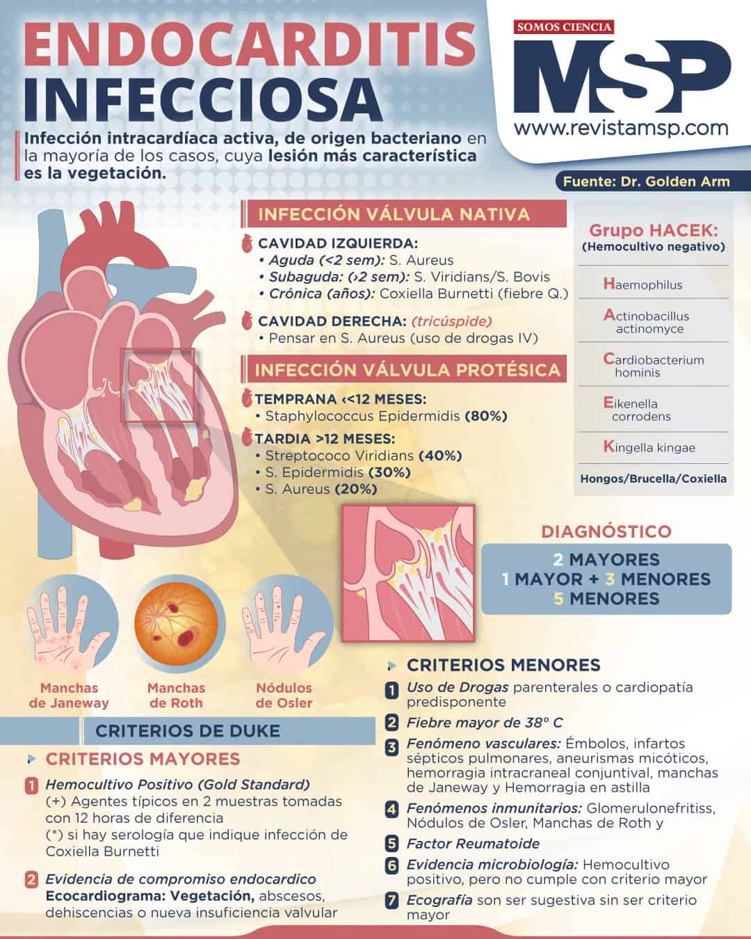 Endocarditis infecciosa