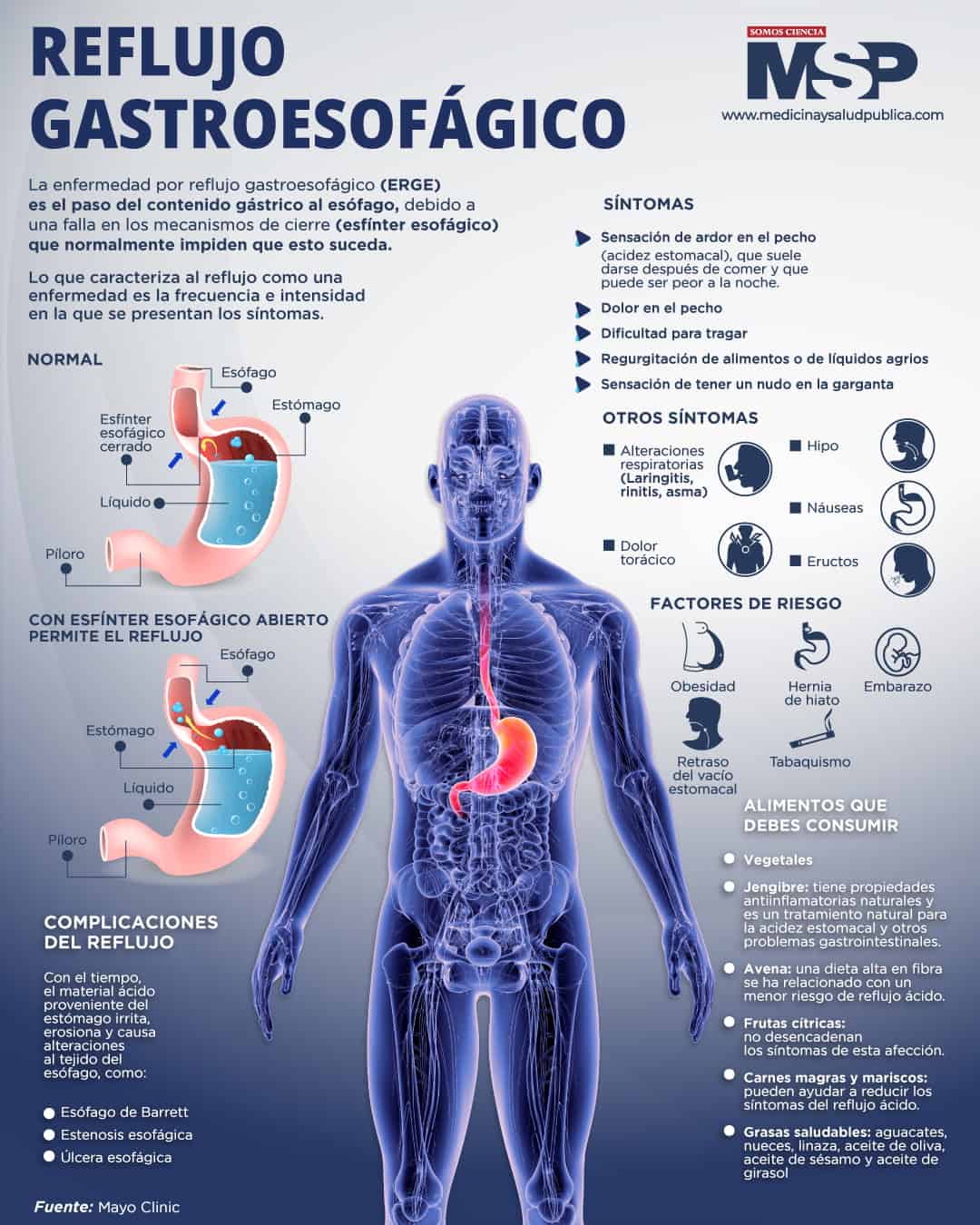 Reflujo gastroesofágico