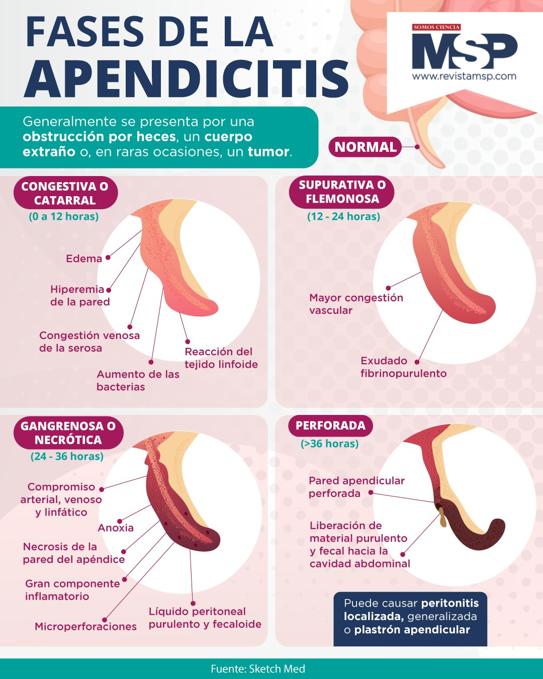 FASES DE LA APENDICITIS