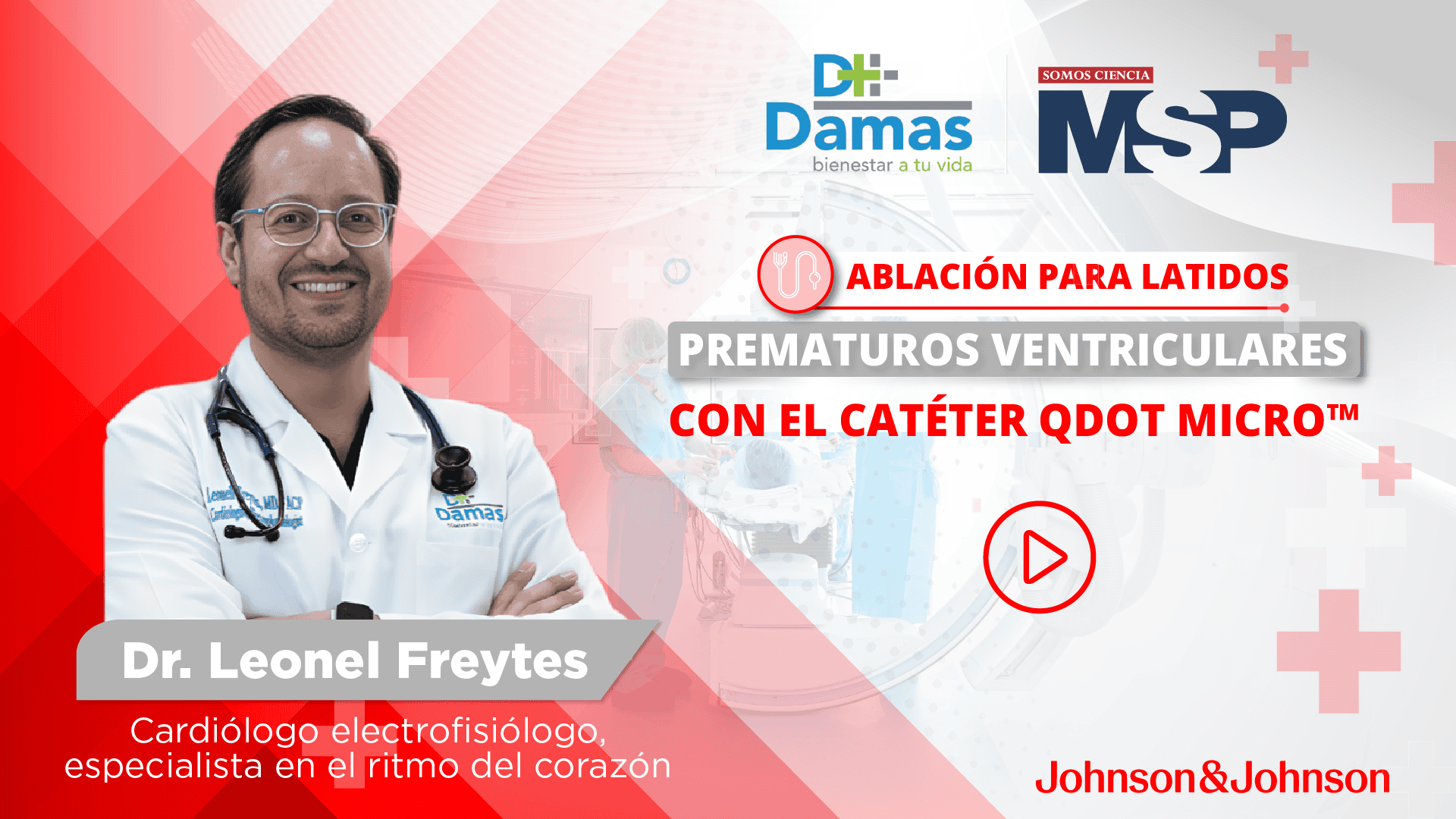 Ablación para latidos prematuros ventriculares con el catéter QDOT MICRO™