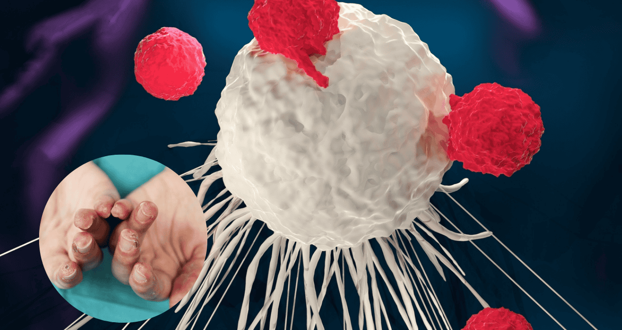 Terapia CAR-T salva por primera vez en el mundo a niña de 11 años con dermatomiositis anti-MDA5